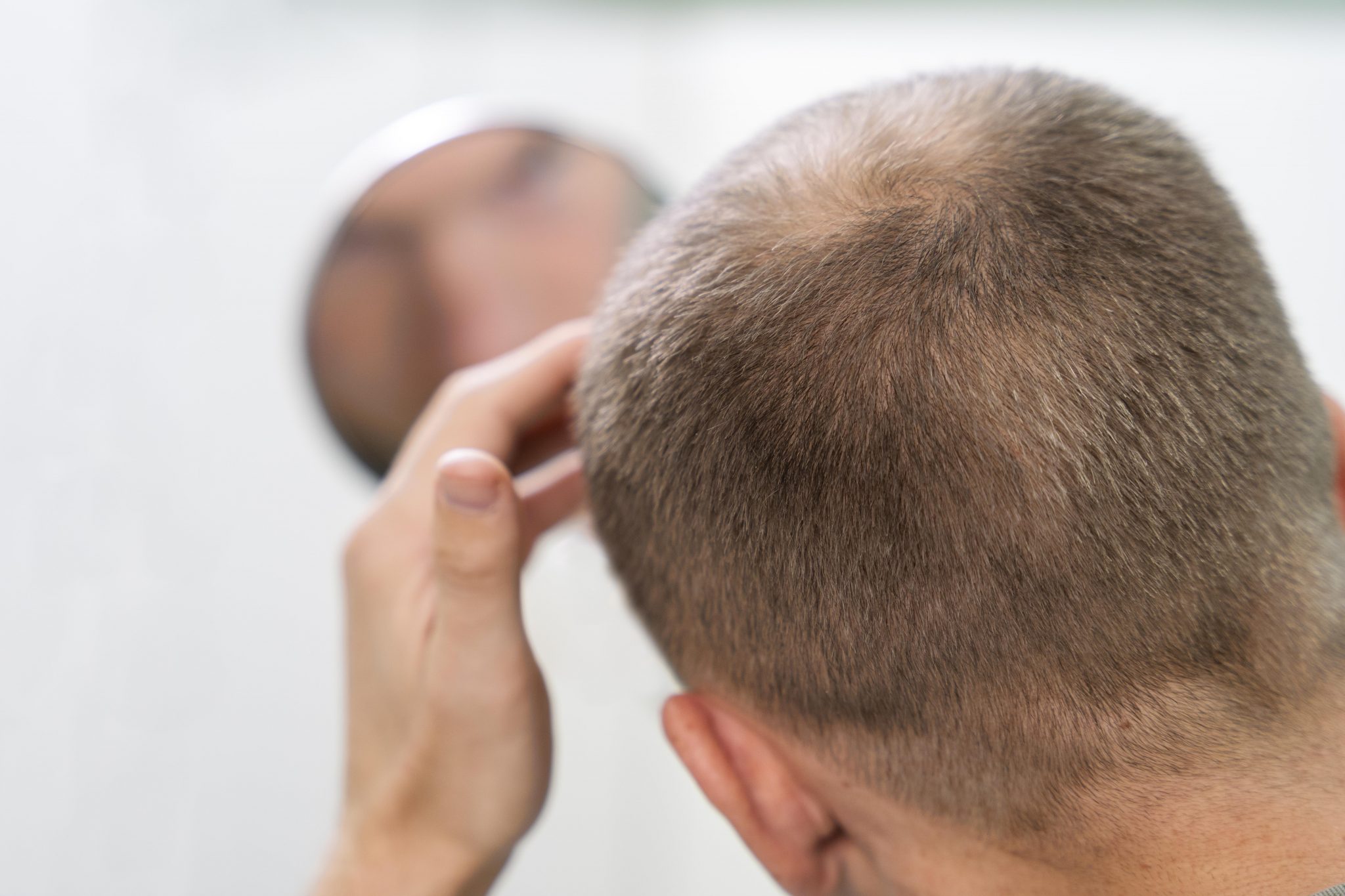 What Blood Tests to Take for Sudden Hair Loss (Alopecia)? | Personalabs