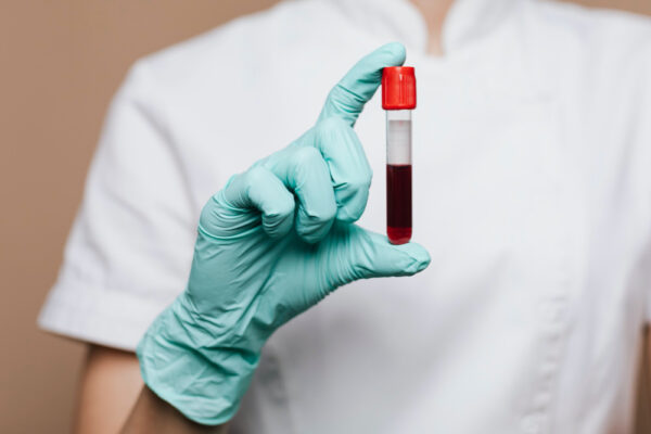What Does It Mean If Your MCV Blood Test Is High? Personalabs